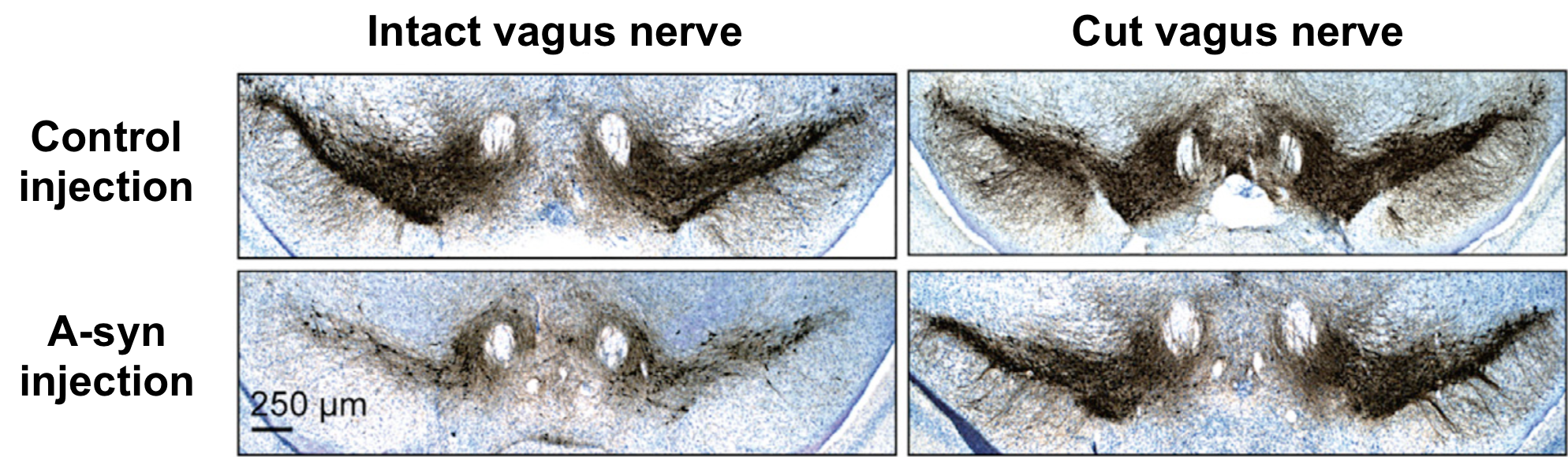 Where does Parkinson’s Disease come from? – Fresh Science Explained